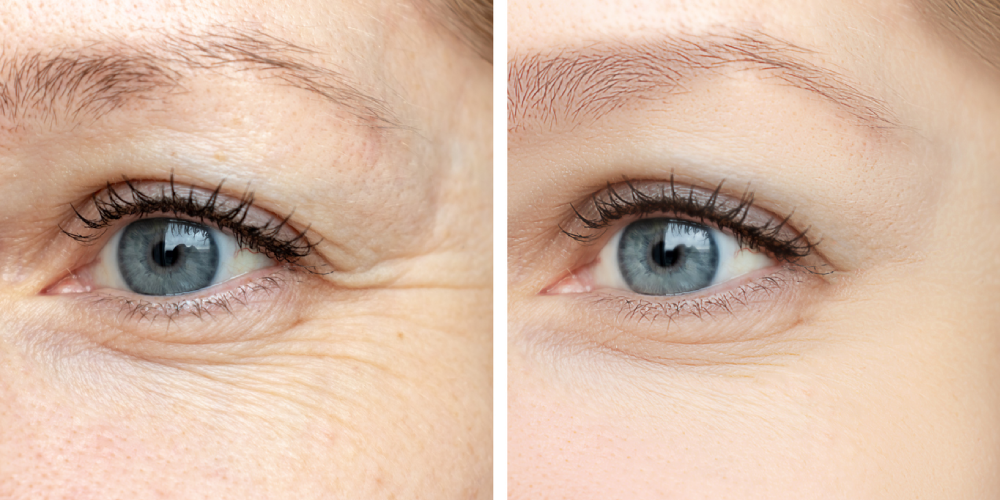 Laser Eye Wrinkle Reduction Treatment in Mumbai & Navi Mumbai